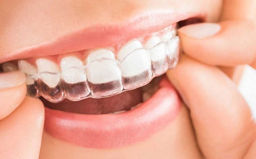 Invisalign Aligners: Everything You Need to Know